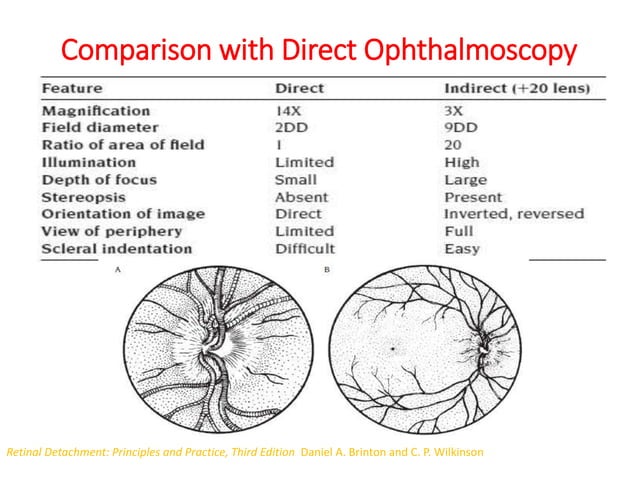 Indirect ophthalmoscopy | PPTX | Eye and Vision Conditions | Diseases ...