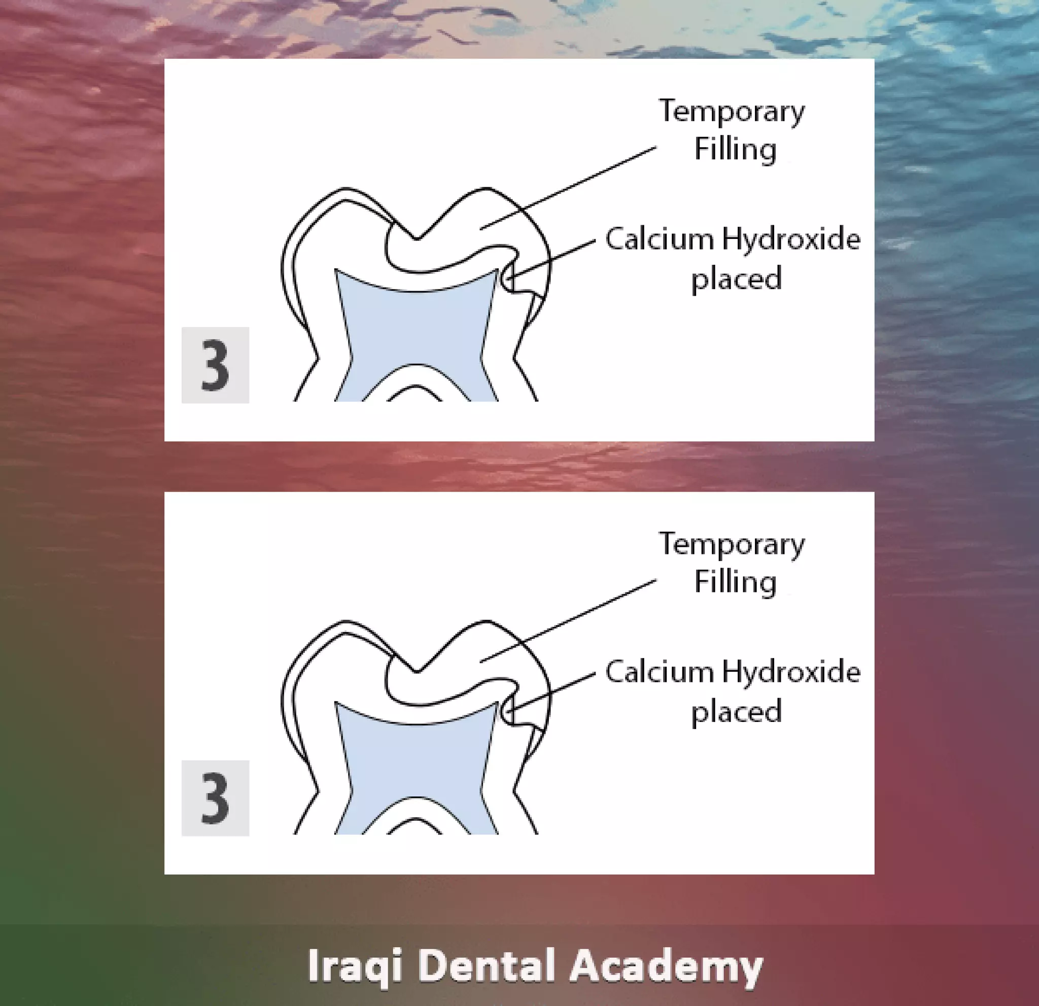 Indirect Pulp Capping Procedure | PDF