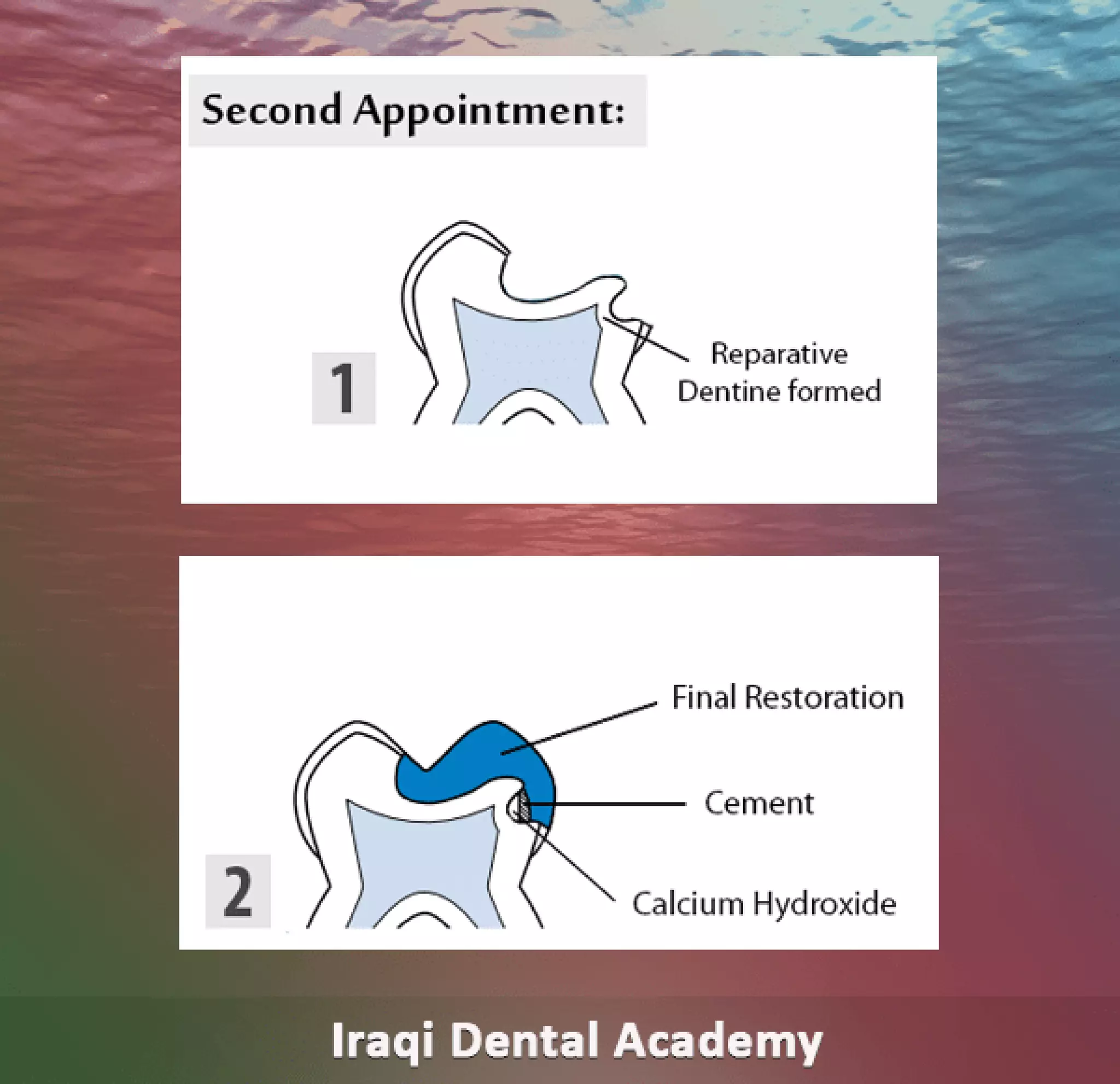 Indirect Pulp Capping Procedure | PDF