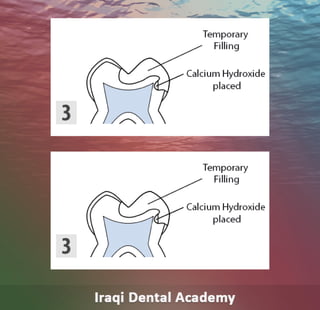 Indirect Pulp Capping Procedure | PDF