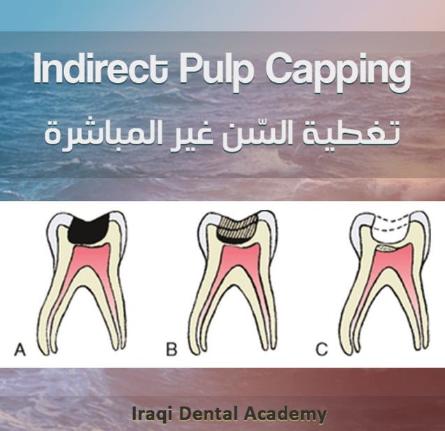Indirect Pulp Capping Procedure | PPT Indirect Pulp Capping Procedure | PPT