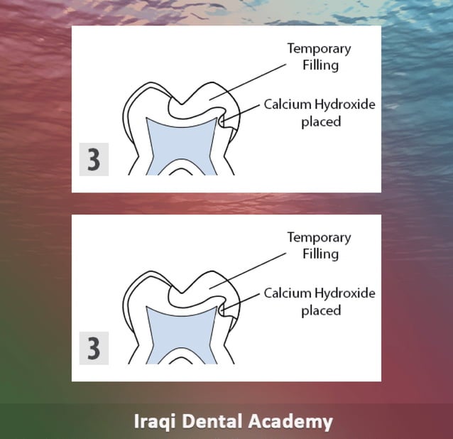 Indirect Pulp Capping Procedure | PPT