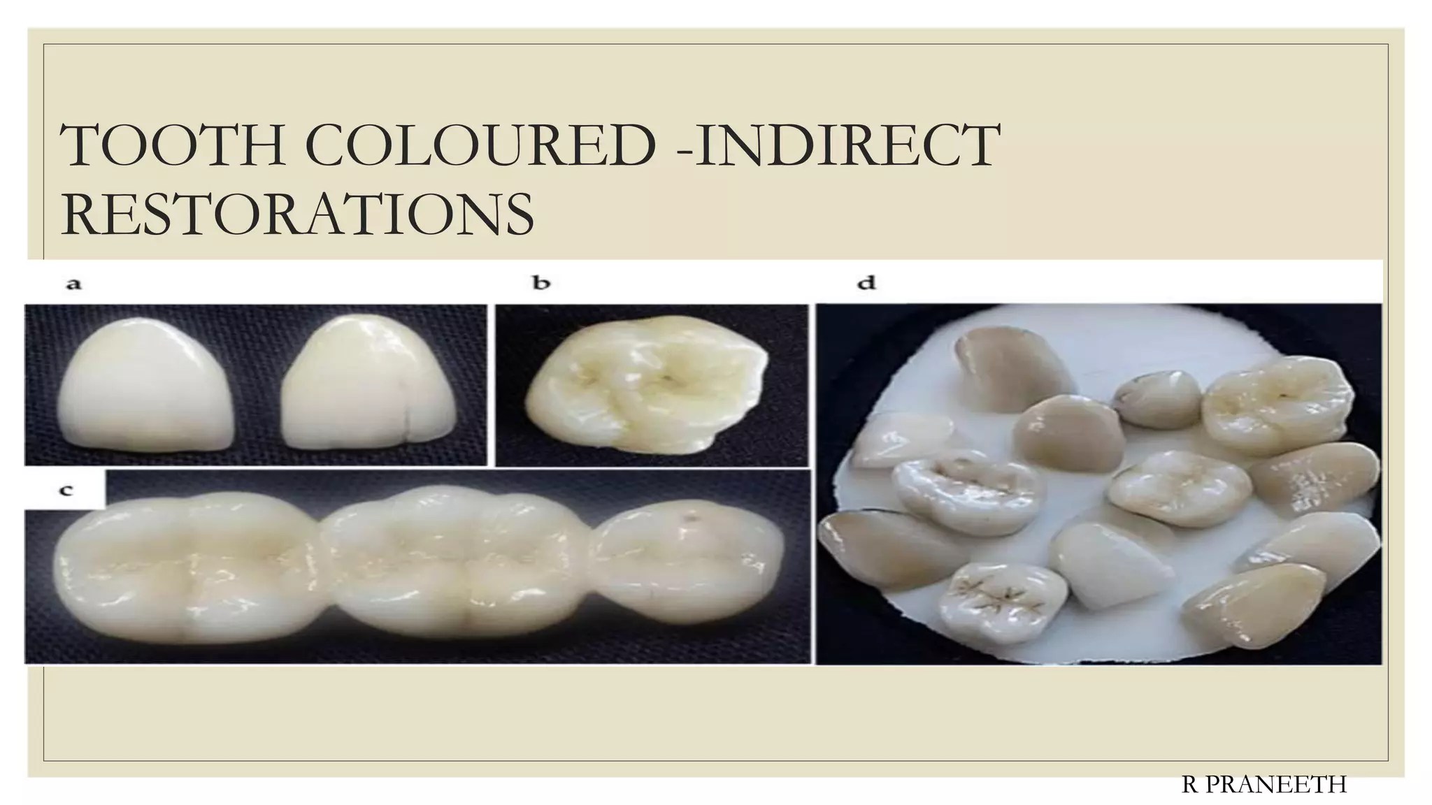 INDIRECT RESTORATIONS.pptx