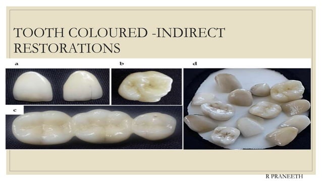 INDIRECT RESTORATIONS.pptx