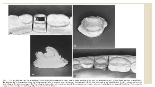 INDIRECT RESTORATIONS.pptx