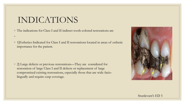 INDIRECT RESTORATIONS.pptx