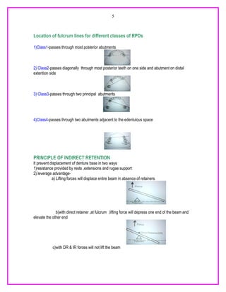 Indirect Retainer | DOC