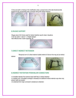 Indirect Retainer | DOC