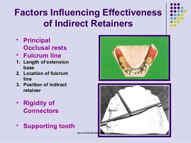 Indirect retainers/prosthodontic courses