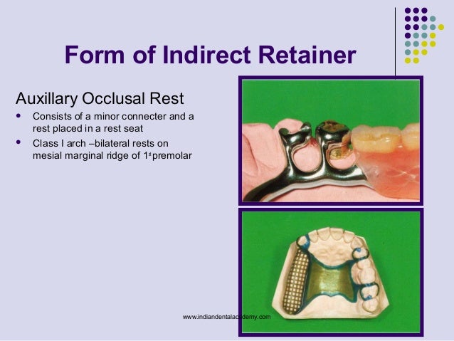 Indirect retainers/prosthodontic courses