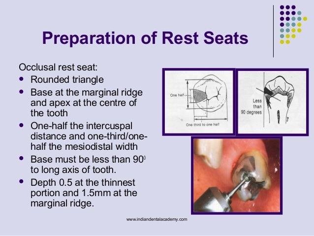 Indirect retainers/prosthodontic courses