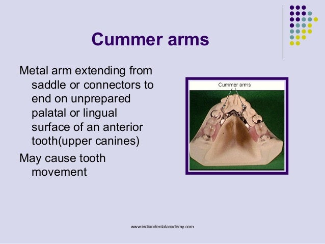 Indirect retainers/prosthodontic courses