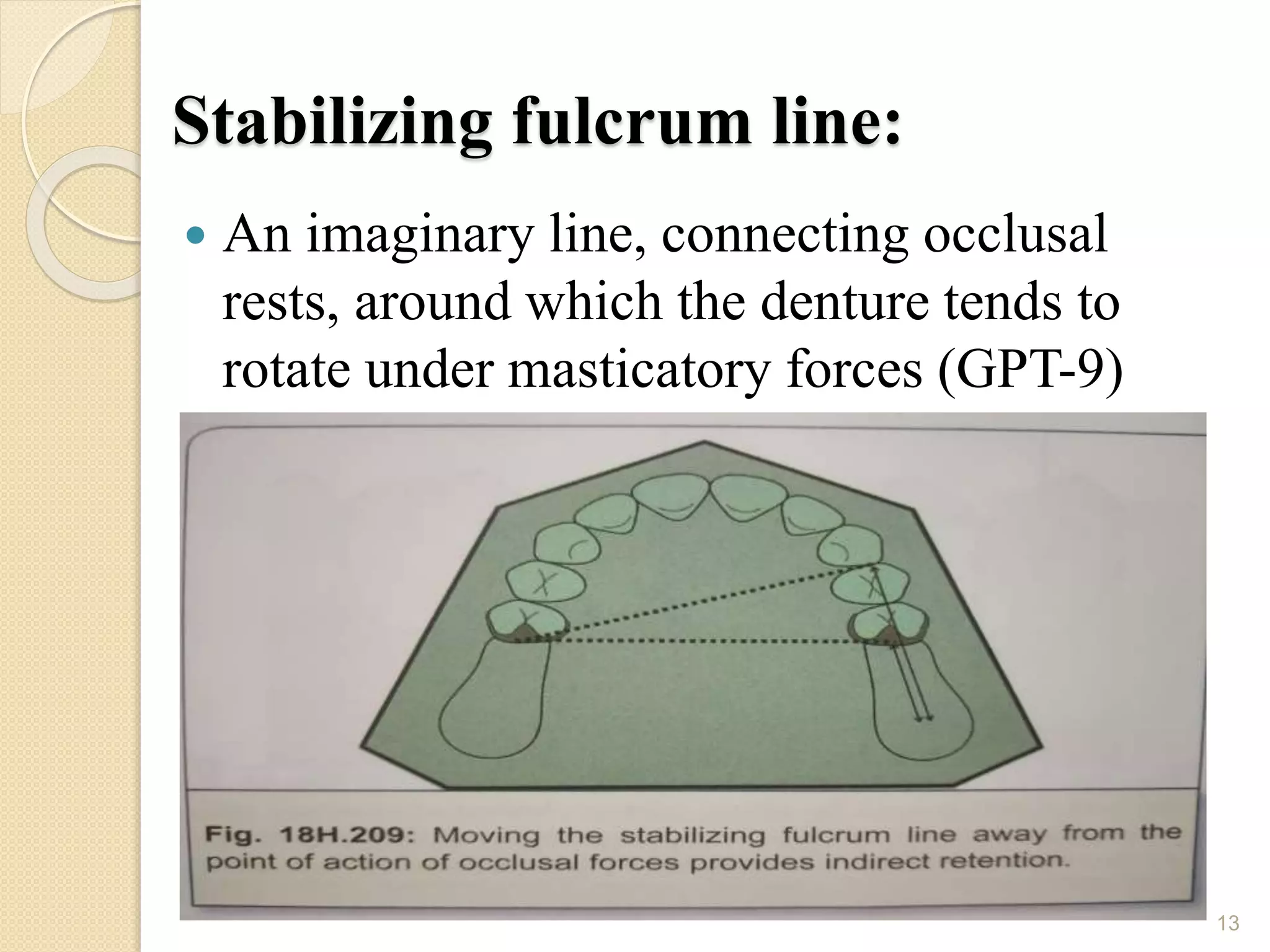 Indirect retainers | PPTX