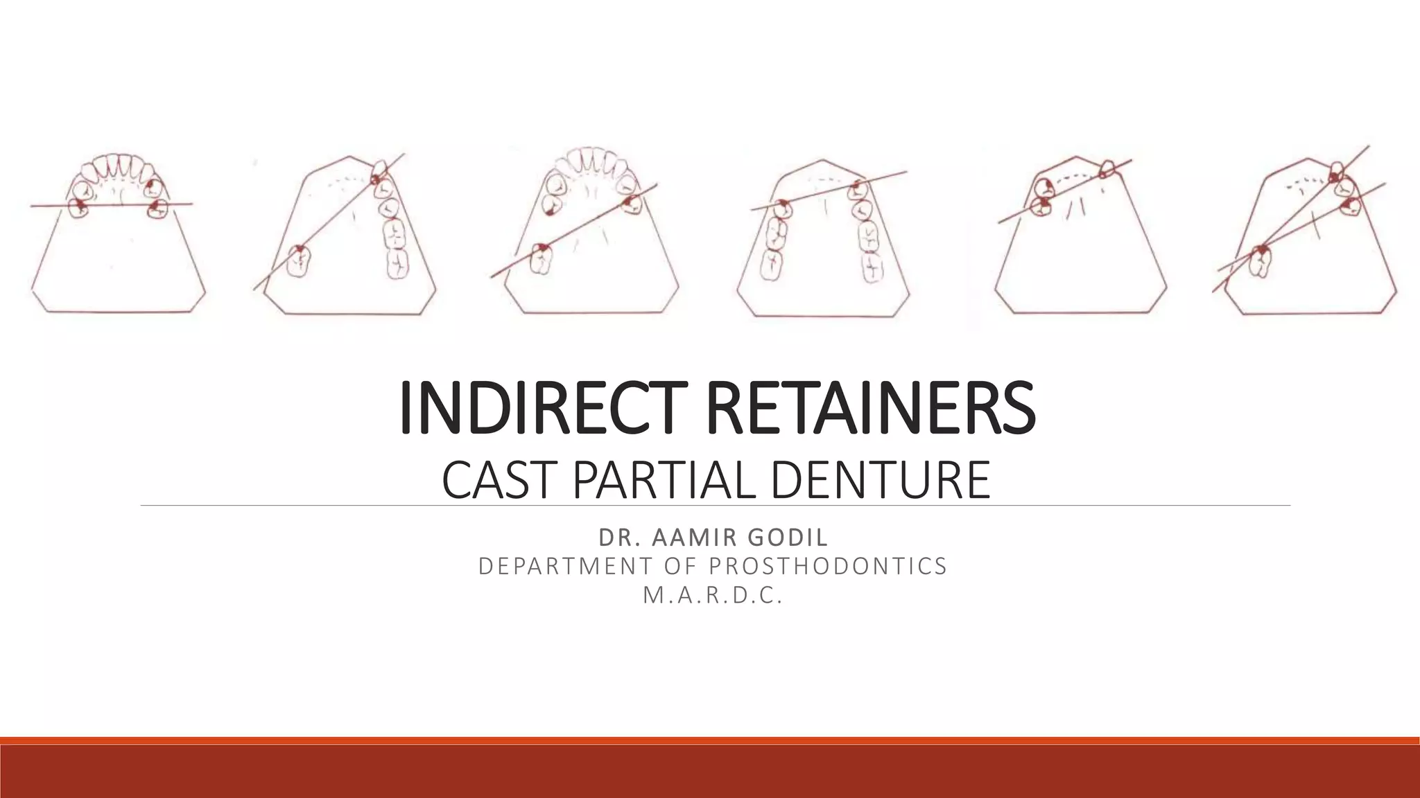 INDIRECT RETAINERS IN CAST PARTIAL DENTURES | PPTX