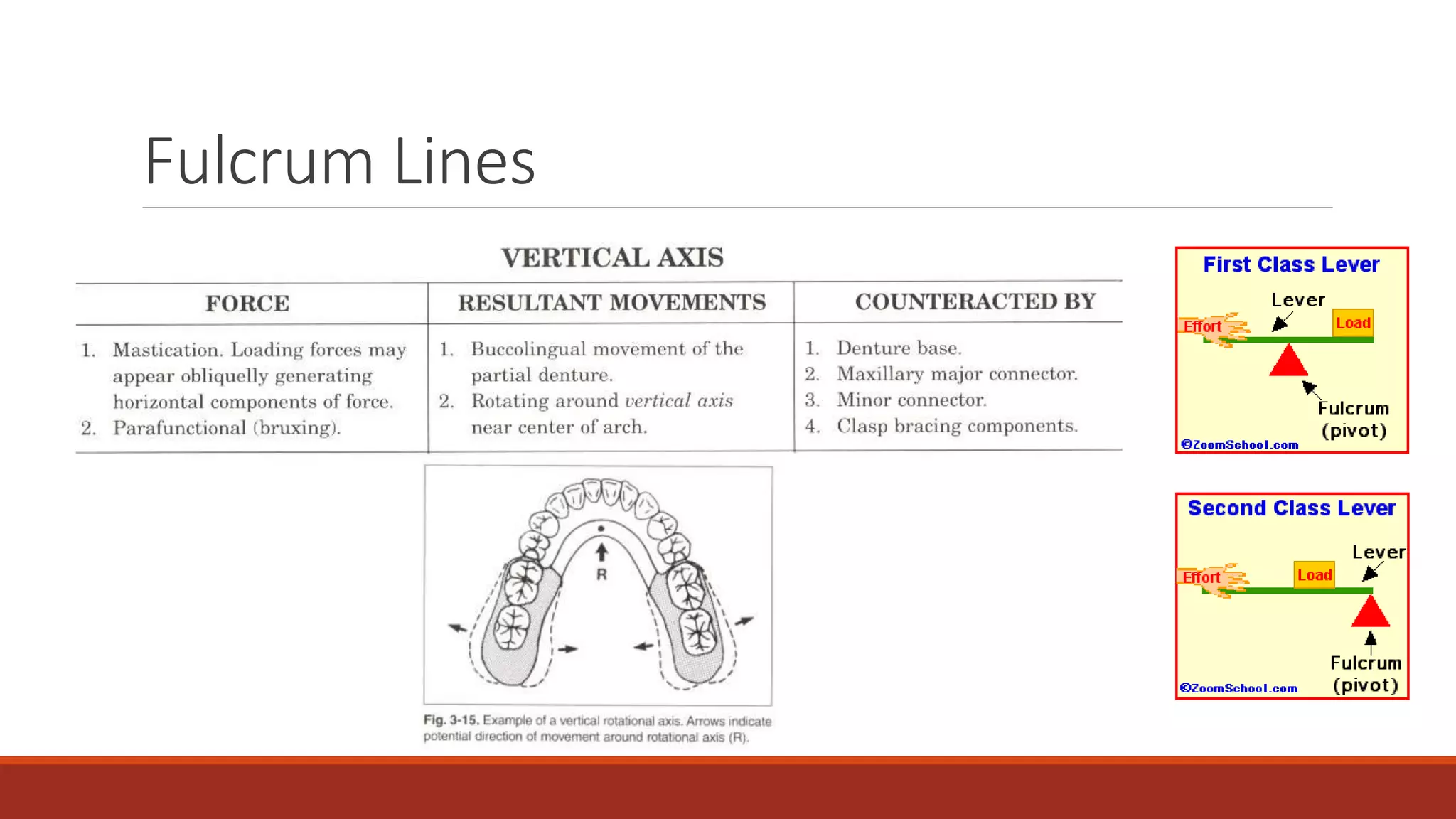 INDIRECT RETAINERS IN CAST PARTIAL DENTURES | PPTX