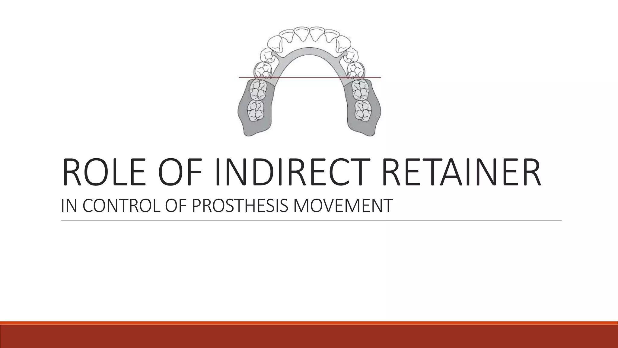 INDIRECT RETAINERS IN CAST PARTIAL DENTURES | PPTX