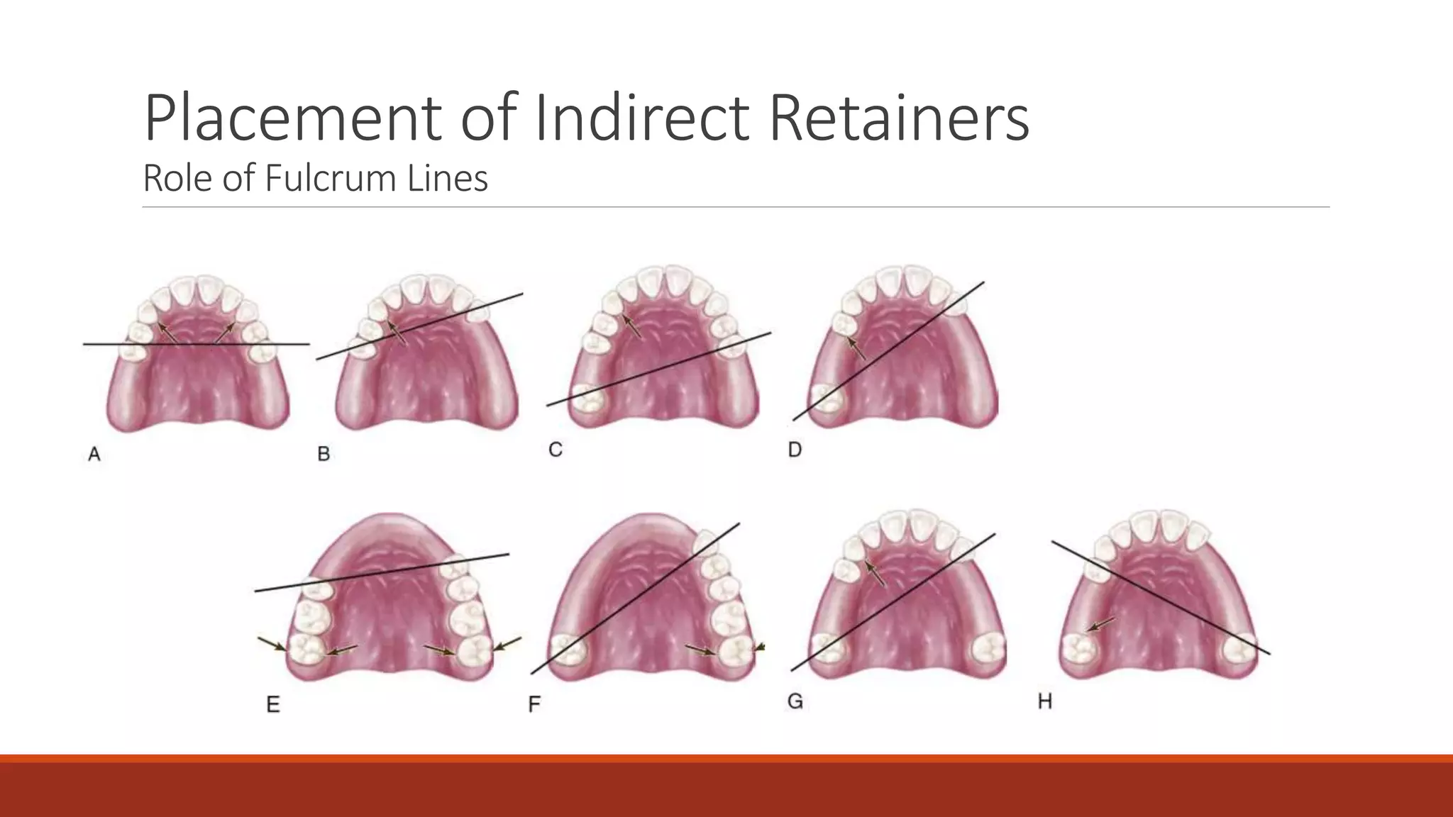 INDIRECT RETAINERS IN CAST PARTIAL DENTURES | PPTX