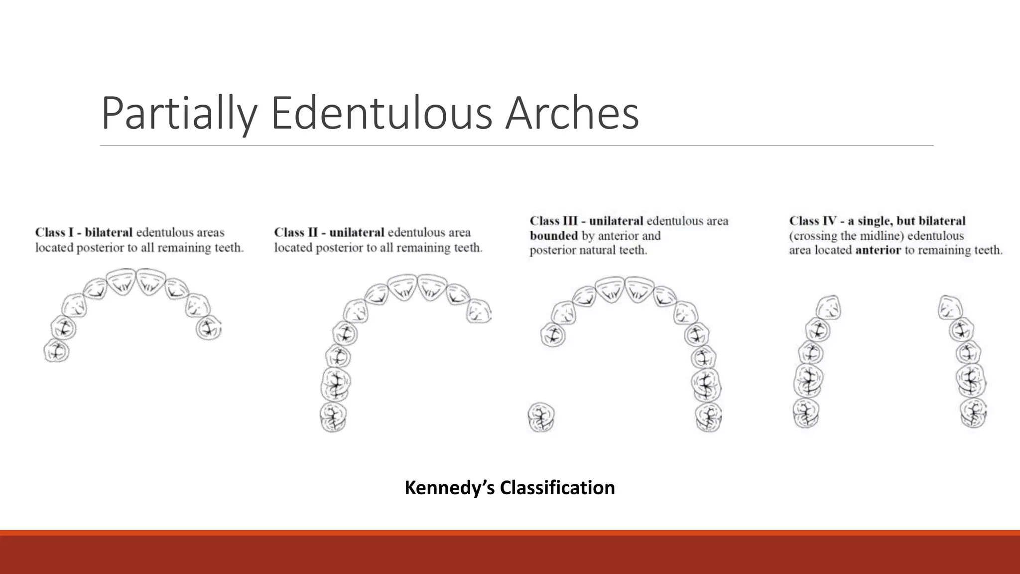 INDIRECT RETAINERS IN CAST PARTIAL DENTURES | PPTX