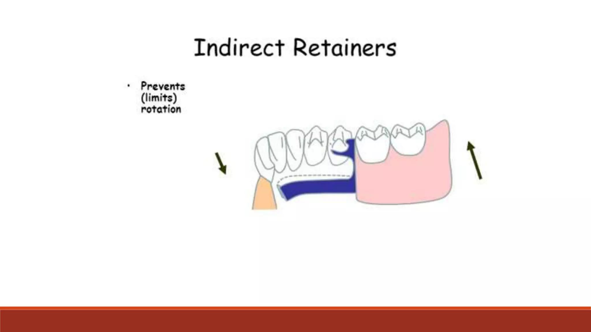 INDIRECT RETAINERS IN CAST PARTIAL DENTURES | PPTX