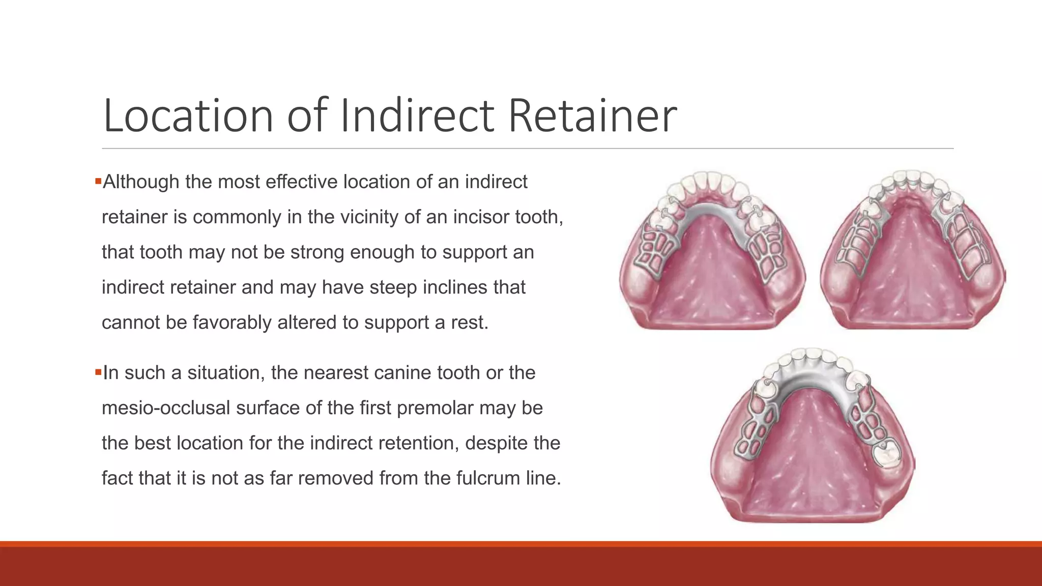 INDIRECT RETAINERS IN CAST PARTIAL DENTURES | PPTX