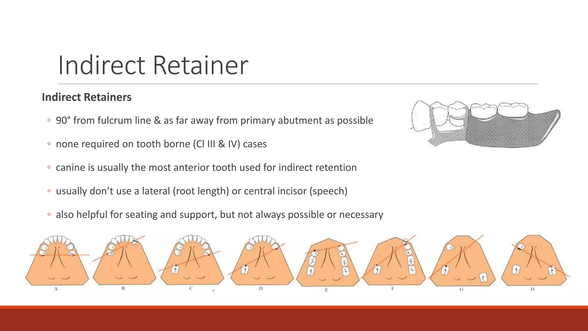 INDIRECT RETAINERS IN CAST PARTIAL DENTURES | PPTX