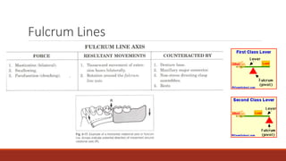 INDIRECT RETAINERS IN CAST PARTIAL DENTURES | PPTX