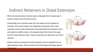 INDIRECT RETAINERS IN CAST PARTIAL DENTURES | PPTX