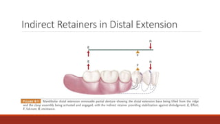 INDIRECT RETAINERS IN CAST PARTIAL DENTURES | PPTX