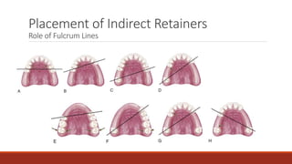 INDIRECT RETAINERS IN CAST PARTIAL DENTURES | PPTX
