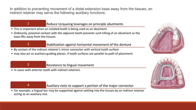 INDIRECT RETAINERS IN CAST PARTIAL DENTURES | PPTX