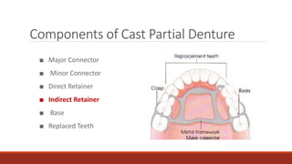 INDIRECT RETAINERS IN CAST PARTIAL DENTURES | PPTX