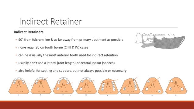 INDIRECT RETAINERS IN CAST PARTIAL DENTURES | PPTX