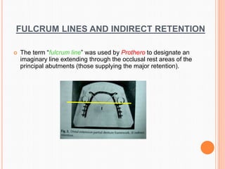 INDIRECT RETAINERS.ppt
