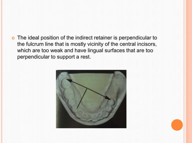 INDIRECT RETAINERS.ppt