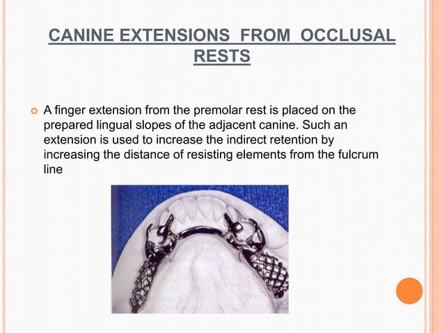 INDIRECT RETAINERS.ppt
