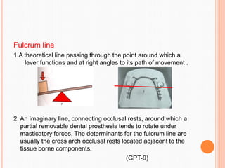 INDIRECT RETAINERS.ppt