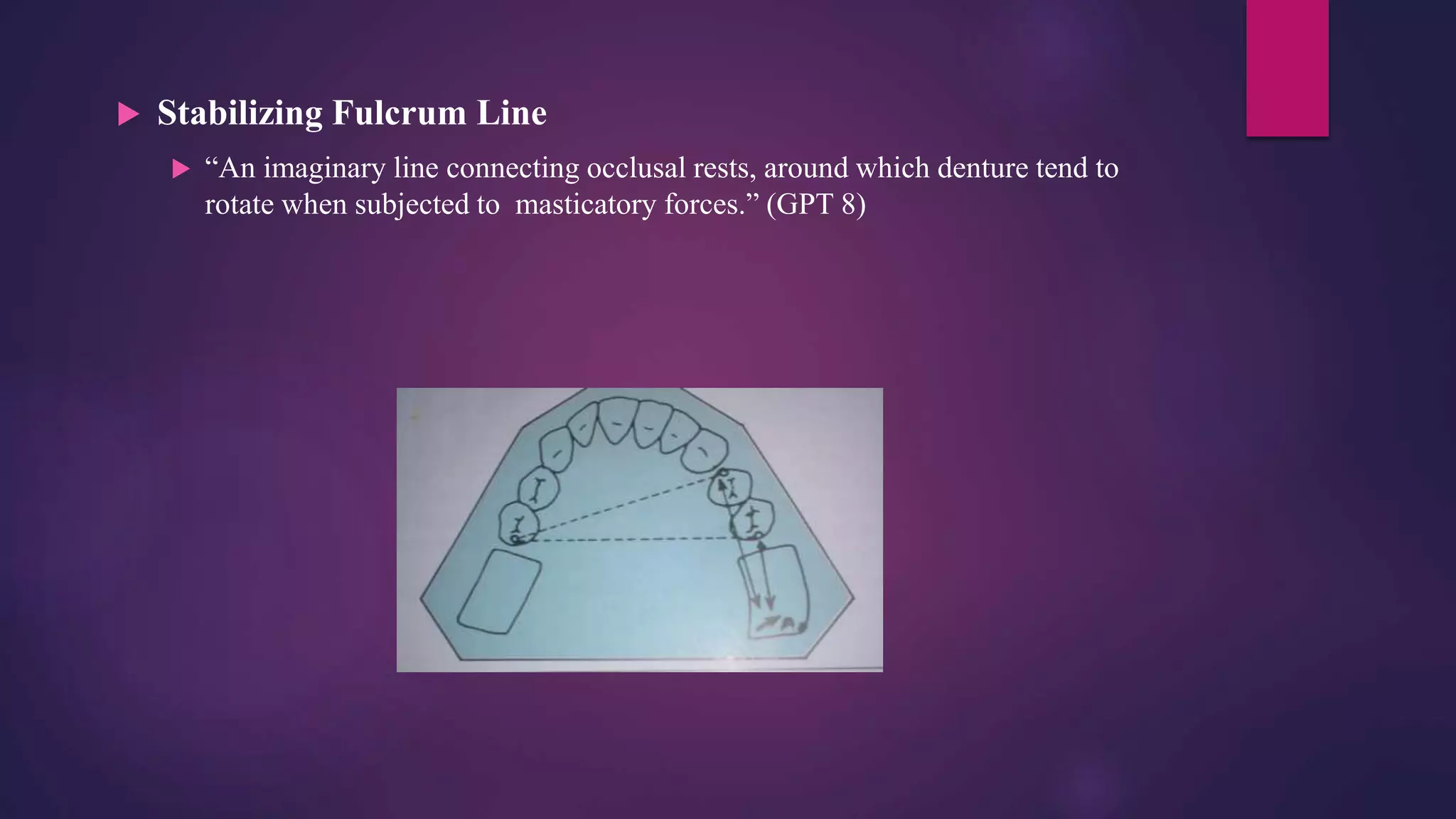 Indirect retainers | PPTX