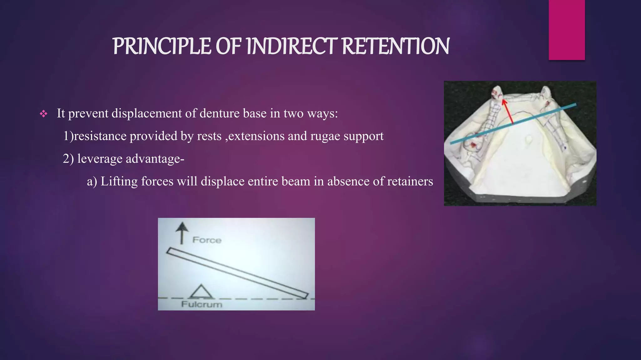 Indirect retainers | PPTX