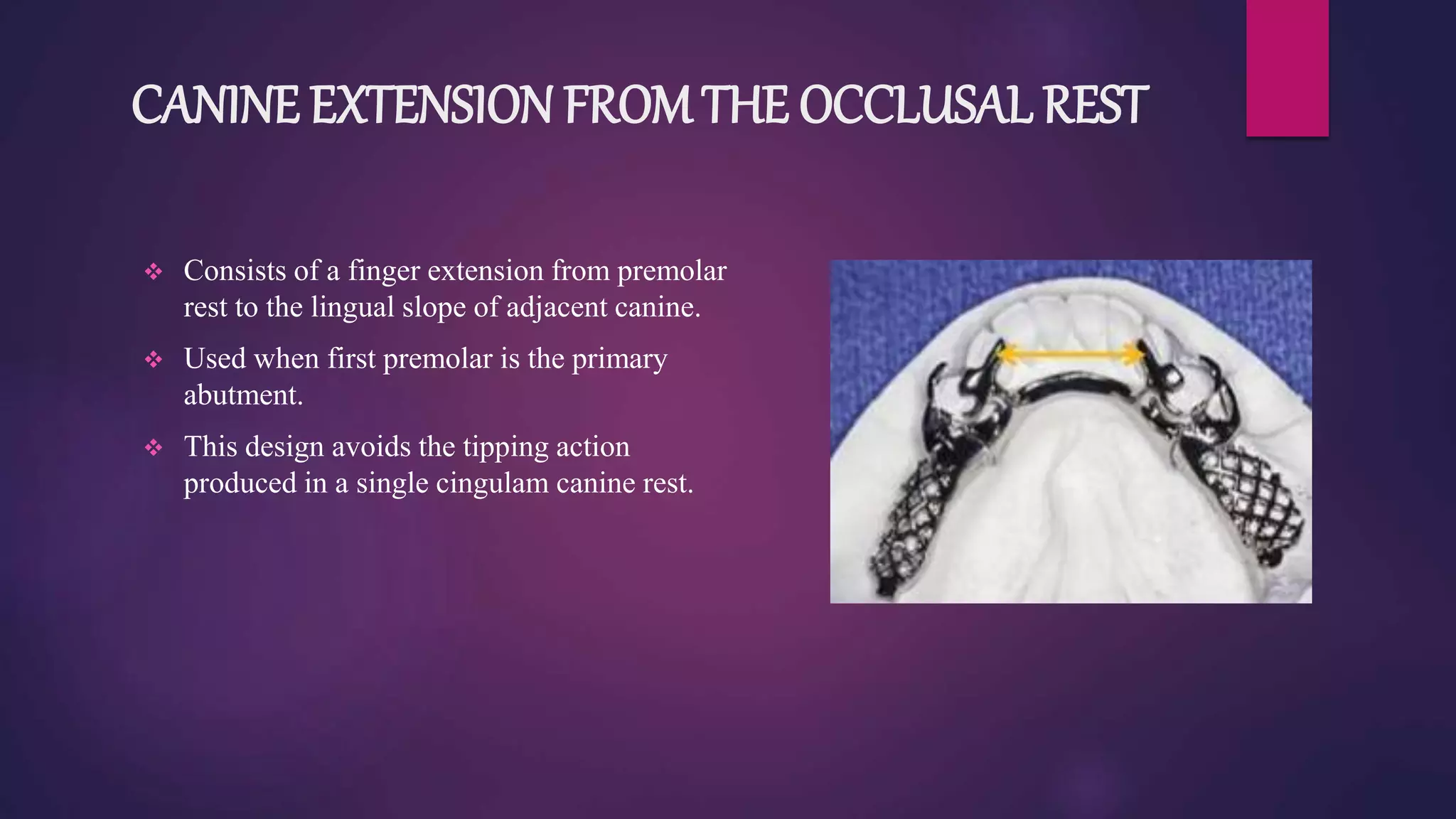 Indirect retainers | PPTX