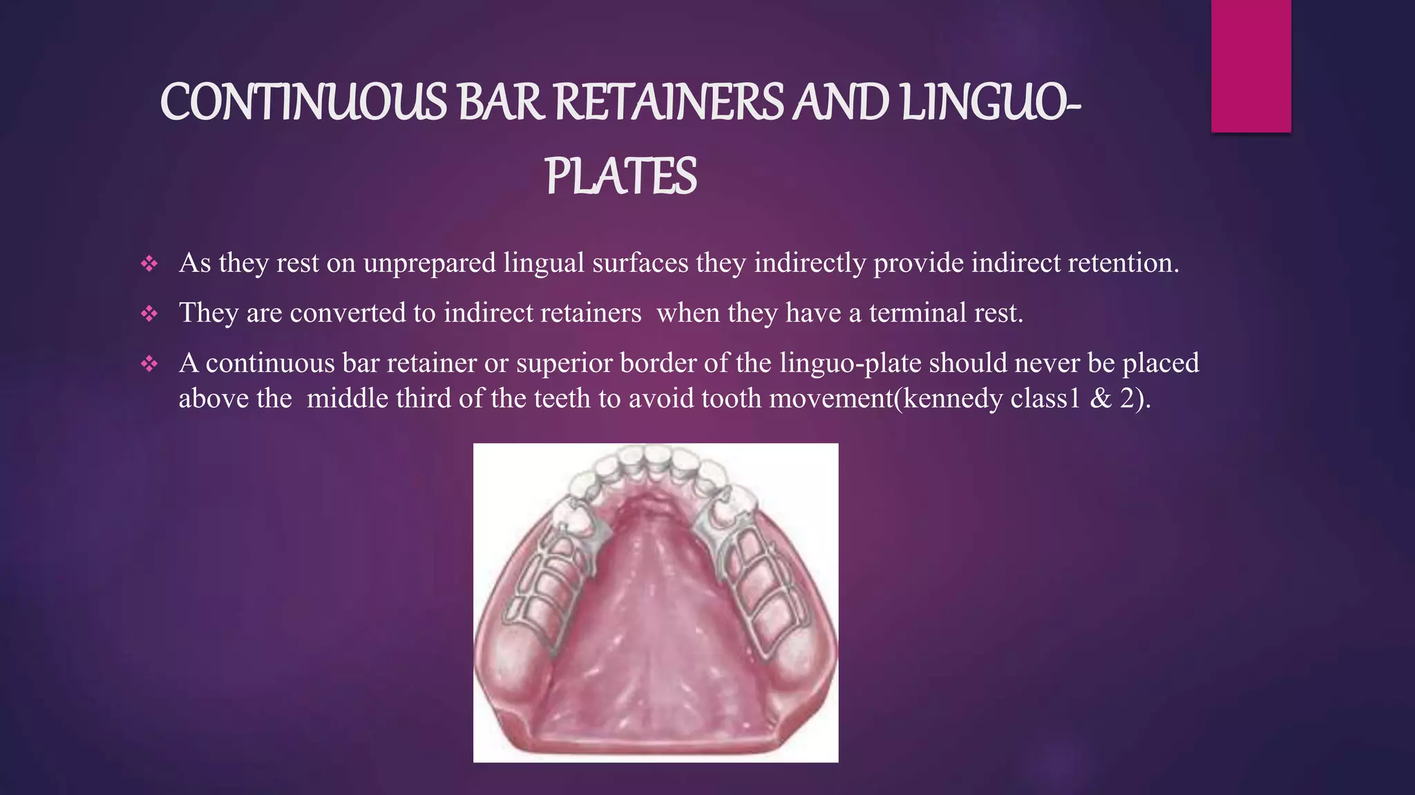 Indirect retainers | PPTX