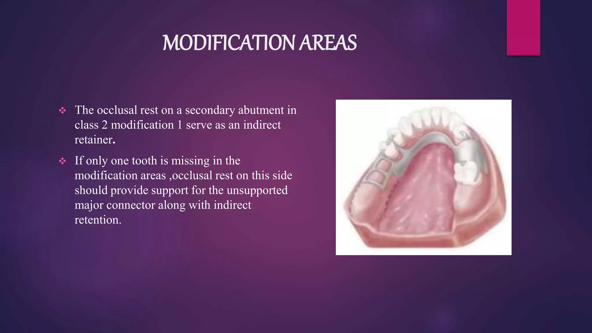 Indirect retainers | PPTX