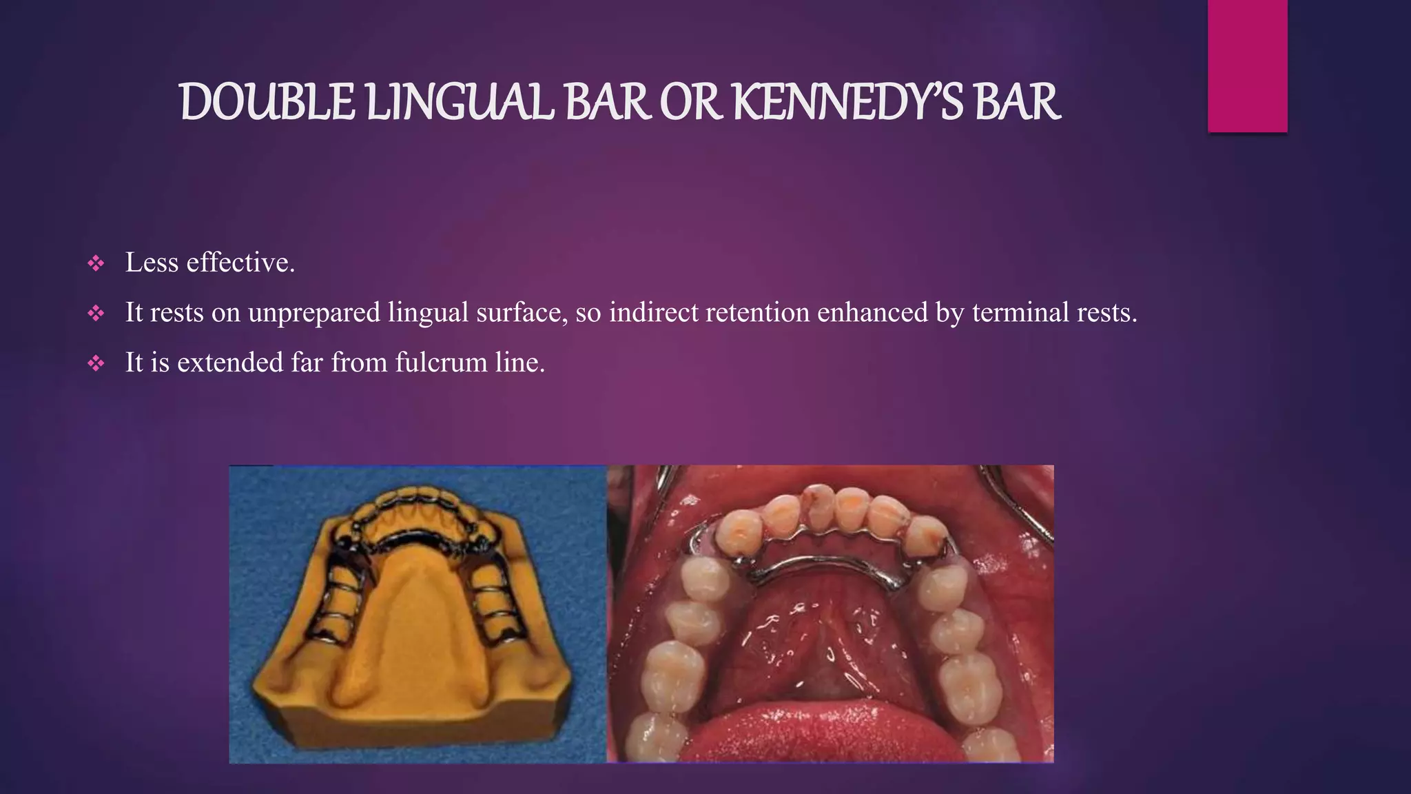 Indirect retainers | PPTX
