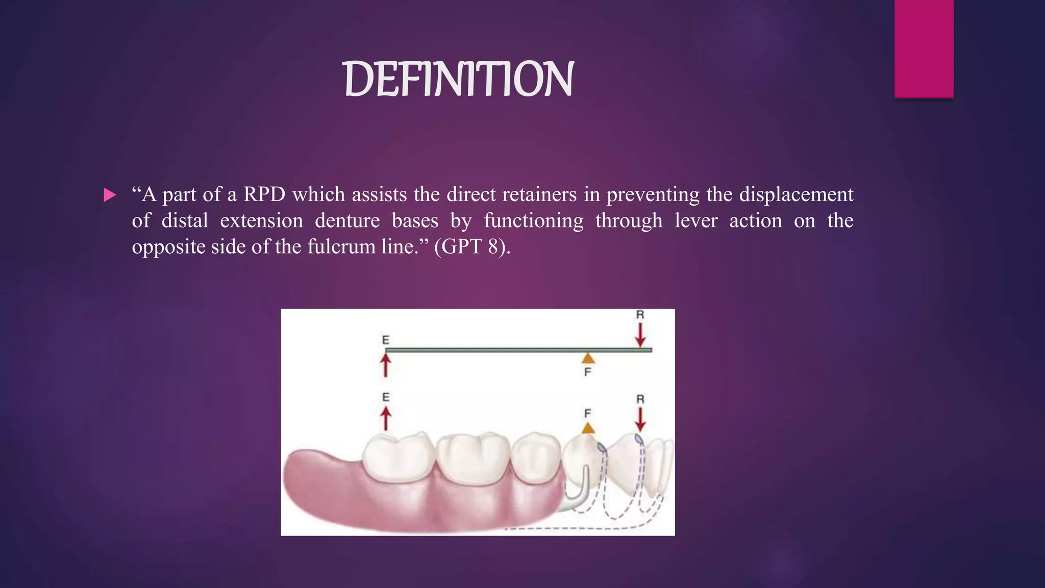 Indirect retainers | PPTX