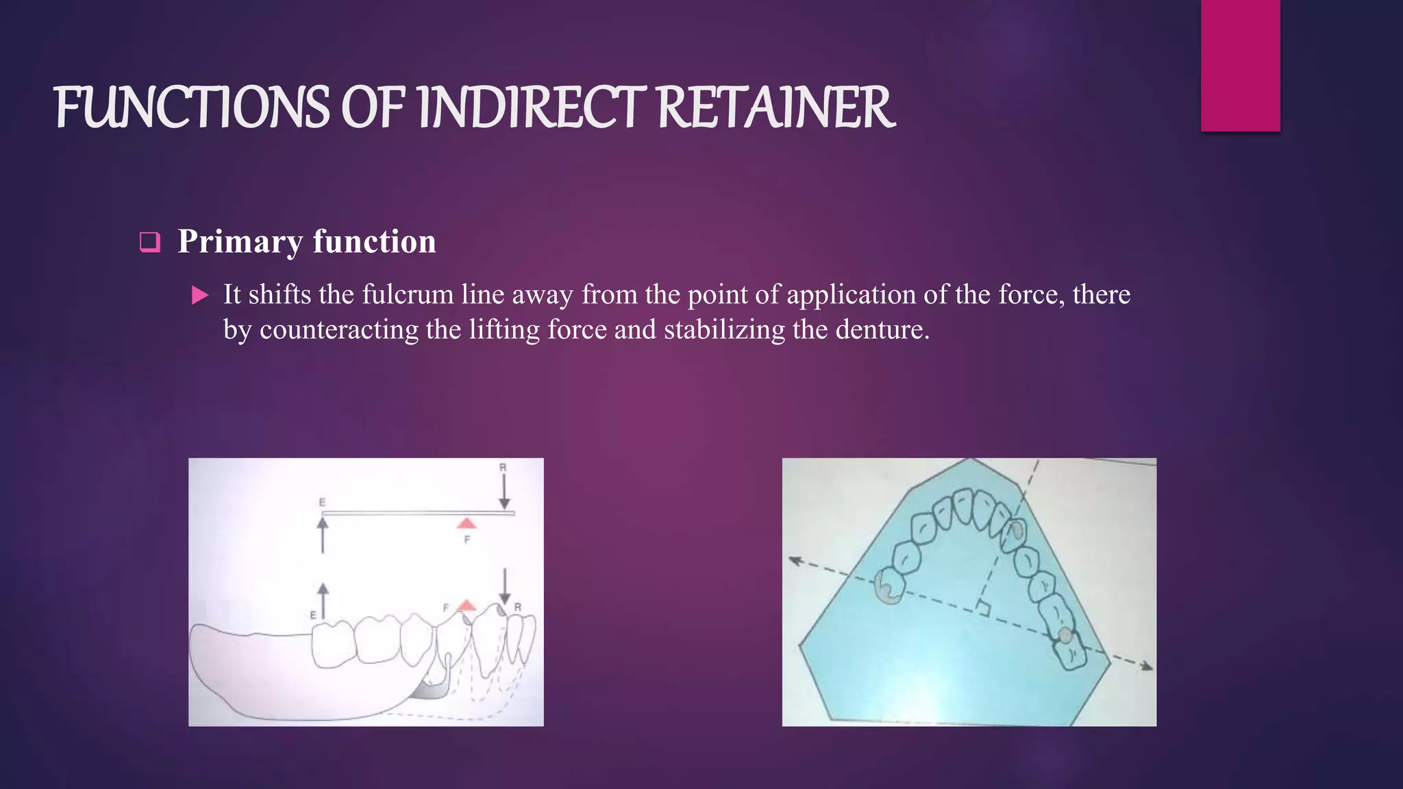 Indirect retainers | PPTX