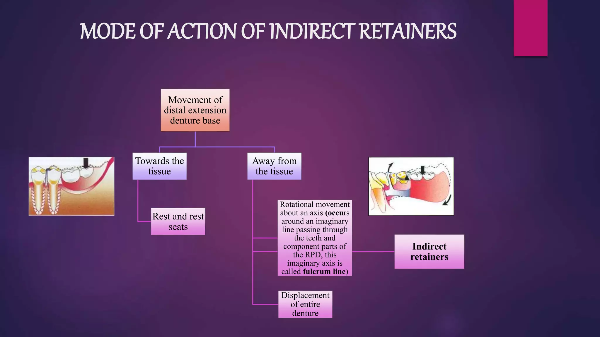 Indirect retainers | PPTX