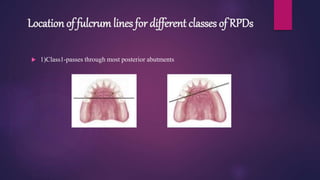 Indirect retainers | PPTX