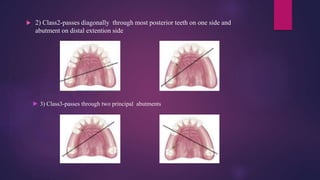 Indirect retainers | PPTX