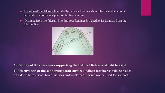 Indirect retainers | PPTX