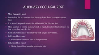 Indirect retainers | PPTX
