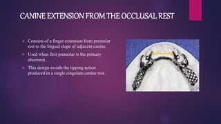 Indirect retainers | PPTX